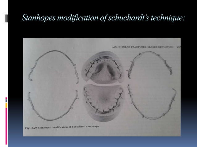 Various intermaxillary fixation techniques | PPTX
