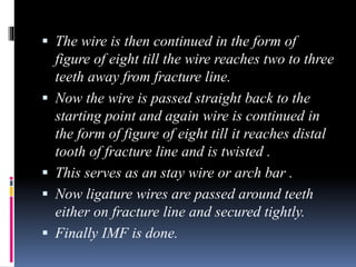 Various intermaxillary fixation techniques | PPTX