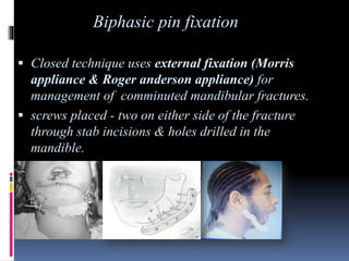 Various intermaxillary fixation techniques | PPTX