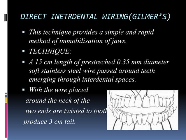 Various intermaxillary fixation techniques | PPTX