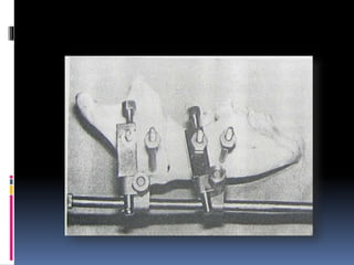 Various intermaxillary fixation techniques | PPTX