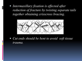 Various intermaxillary fixation techniques | PPTX