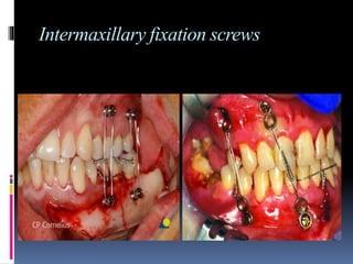 Various intermaxillary fixation techniques | PPTX
