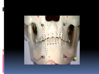 Various intermaxillary fixation techniques | PPTX