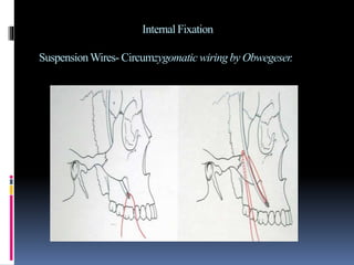 Various intermaxillary fixation techniques | PPTX