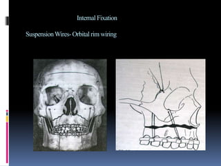 Various intermaxillary fixation techniques | PPTX