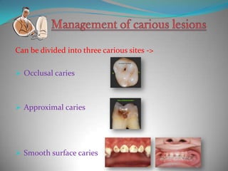 Various methods for preventions of dental caries 4 | PPT