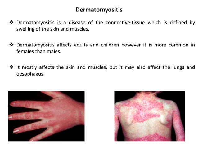 Various rheumatological diseases | PPTX