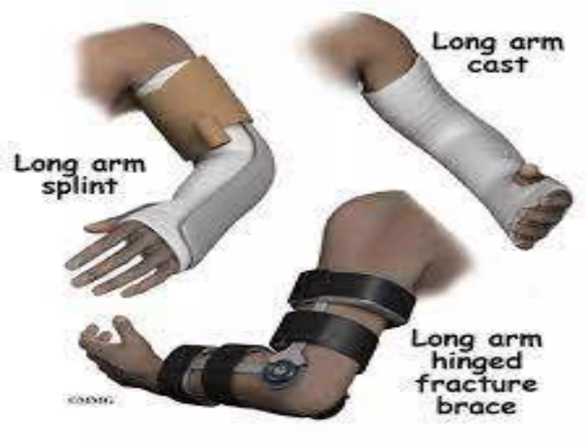Various types of splints and basics | PPTX