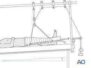 Various types of splints and basics | PPTX