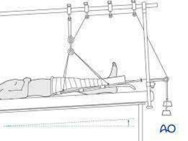 Various types of splints and basics | PPTX