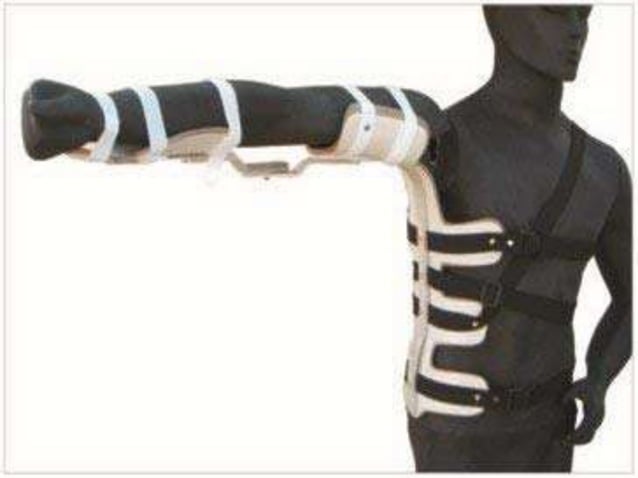 Various types of splints and basics | PPTX