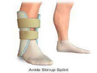 Various types of splints and basics | PPTX