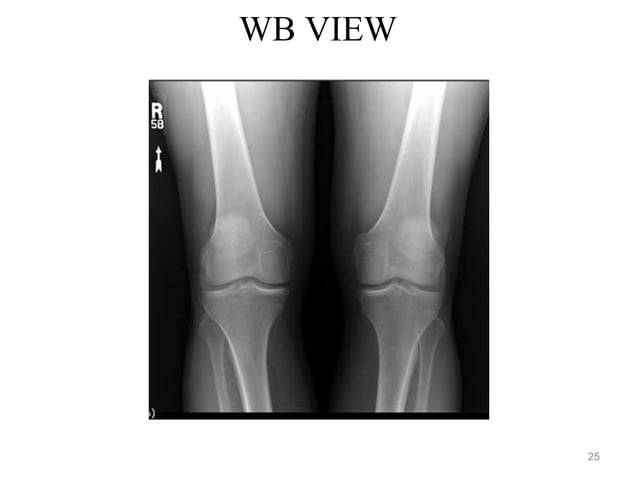Various X-ray views of Knee Joint | PPT | Death, Injury, or Military ...