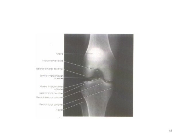 Intercondylar Fossa X Ray
