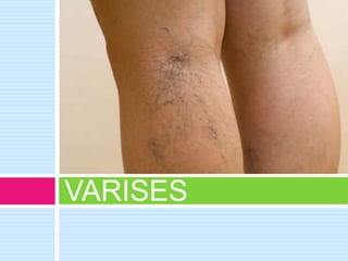 Varises | PPTX