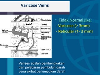 VARISES dan jenis jenis penanganan nya.ppt