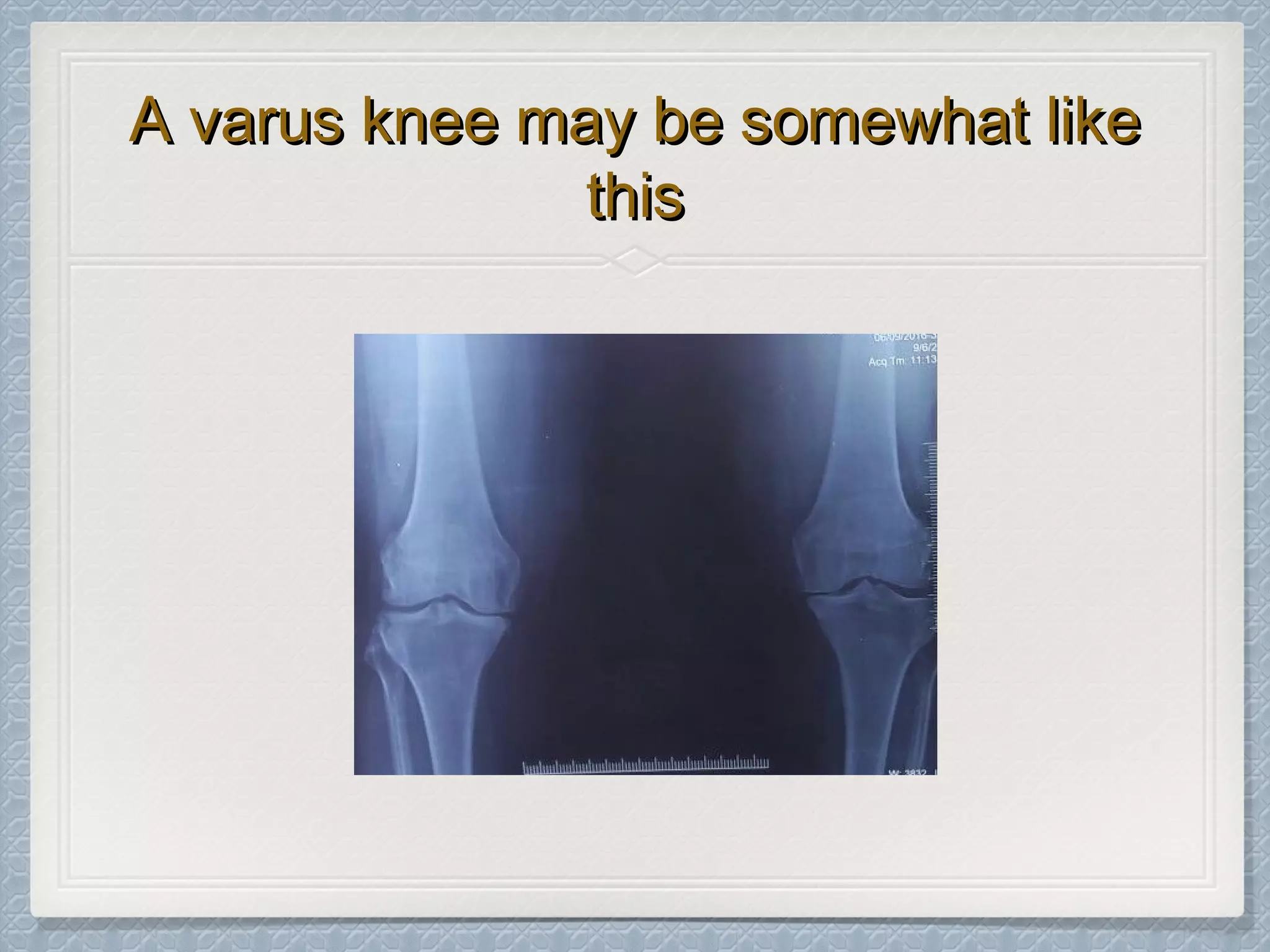 Varus scenarios in indian knee | PPT
