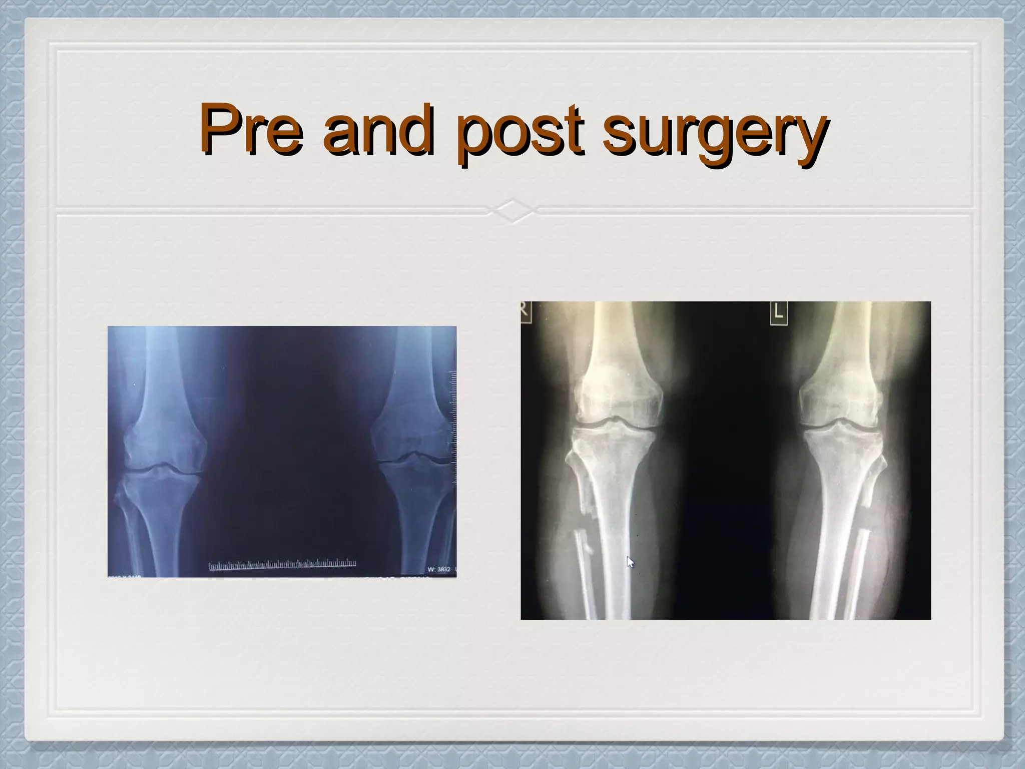 Varus scenarios in indian knee | PPT