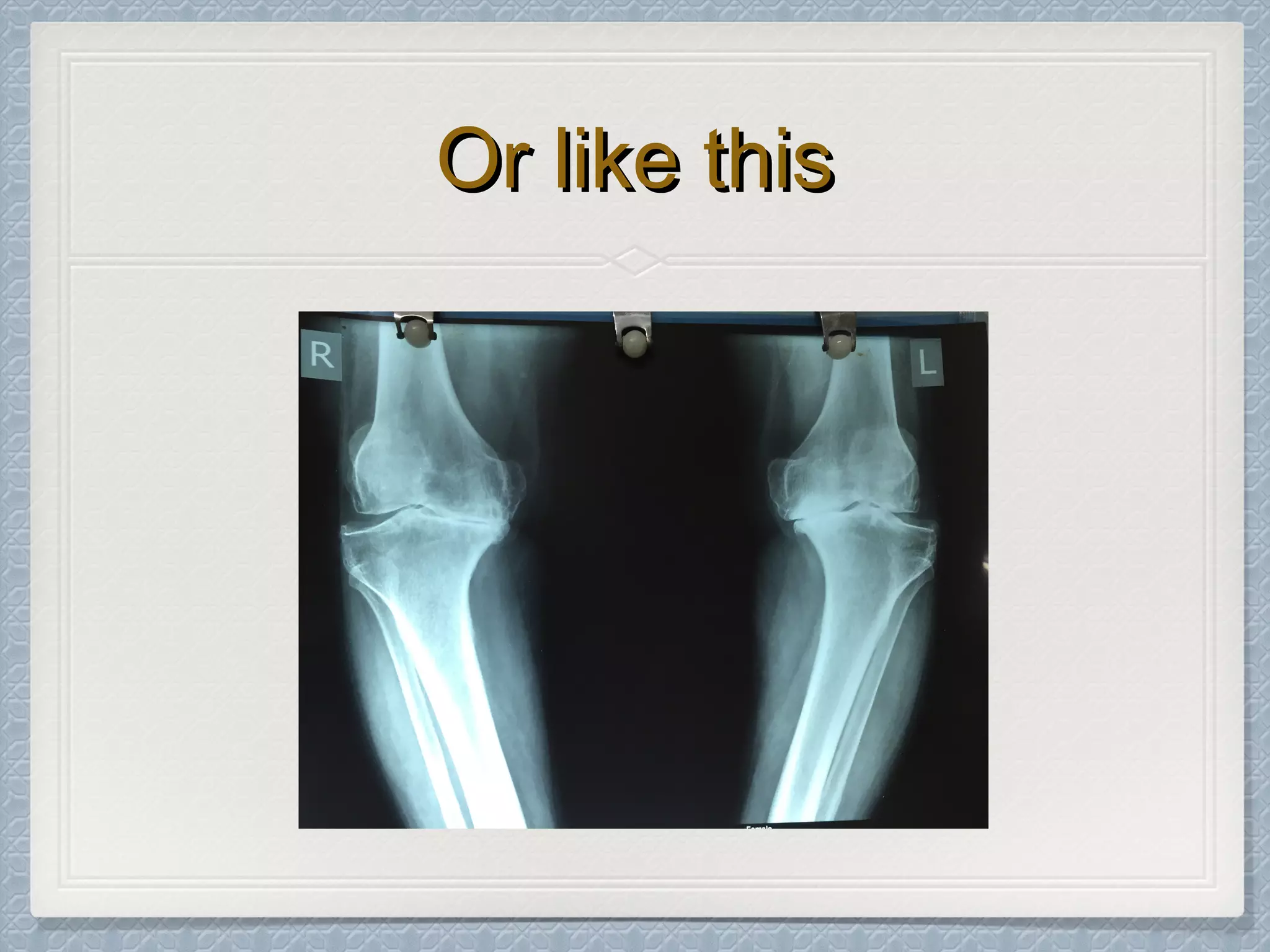 Varus scenarios in indian knee | PPT