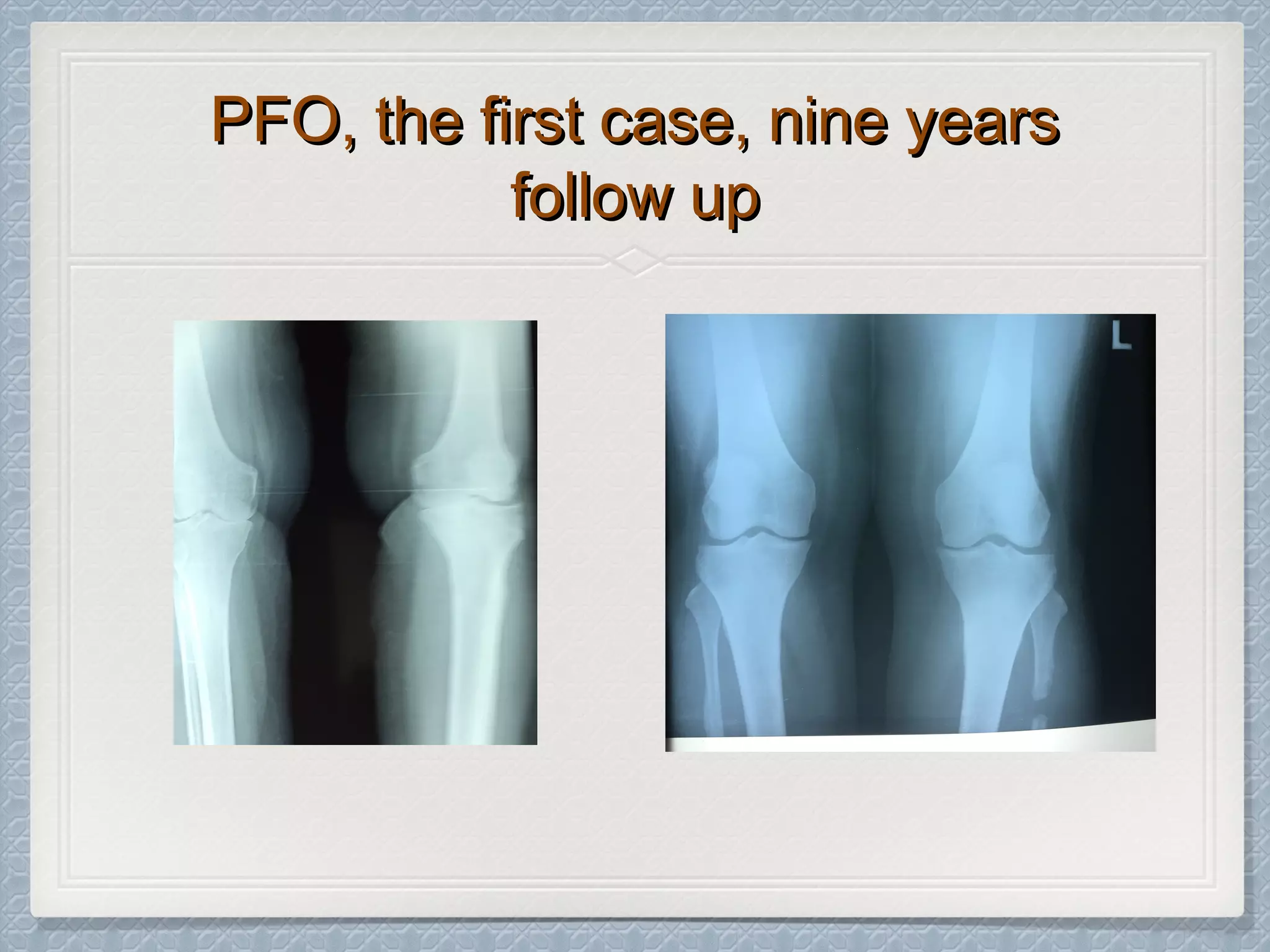 Varus scenarios in indian knee | PPT