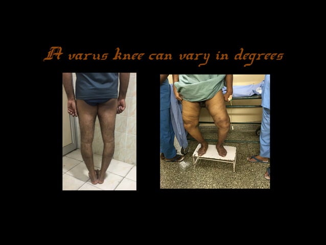 Varus scenarios in indian knee | PPT