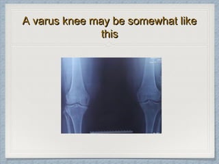 Varus scenarios in indian knee | PPT