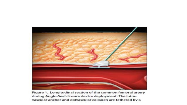 Vascular closure devices | PPTX | First Aid | Injuries