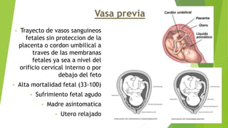 Vasa previa | PPTX