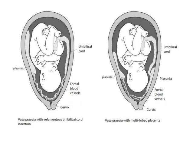 Vasa previa