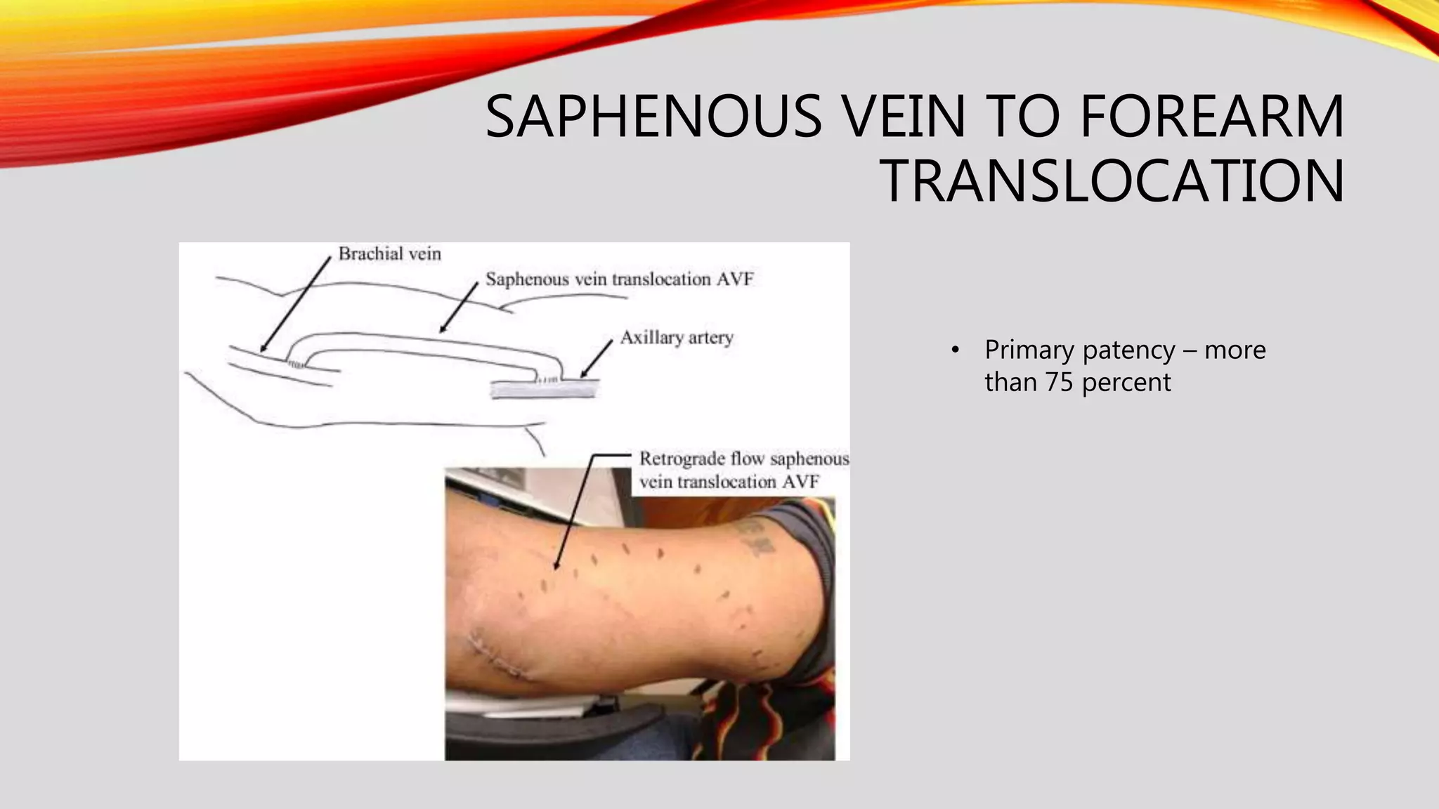 Vascular / Hemo Dialysis Access | PPTX