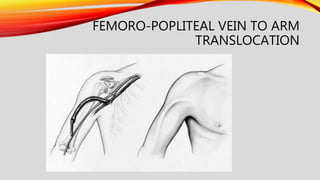 Vascular / Hemo Dialysis Access | PPTX