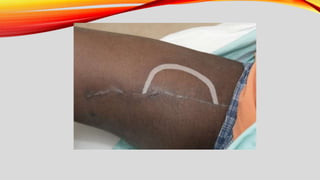 Vascular / Hemo Dialysis Access | PPTX
