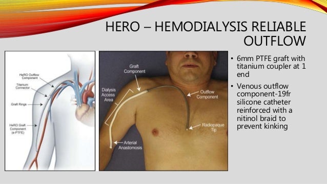 3 Types Of Vascular Access Ports Used In Hemodialysis