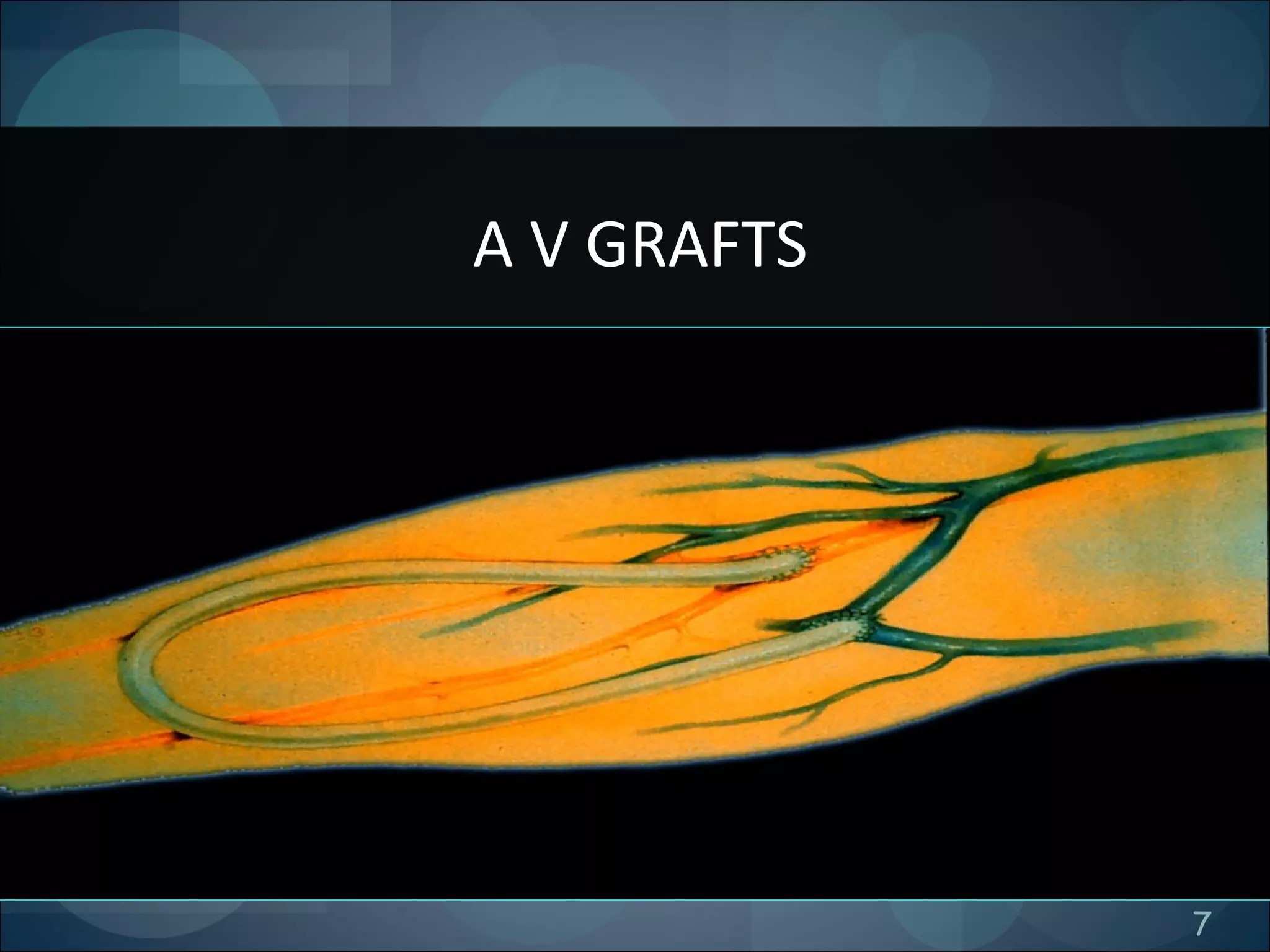 Vascular access for hemodialysis( AVF ) | PPT