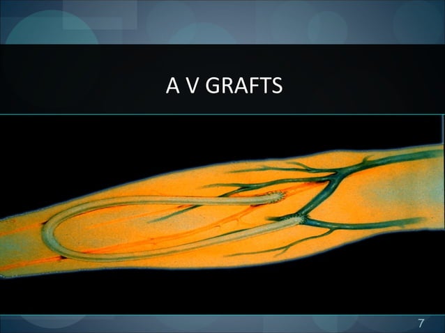 Vascular access for hemodialysis( AVF ) | PPT | First Aid | Injuries