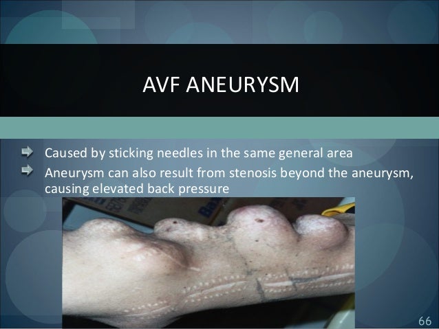 Vascular access for hemodialysis( AVF )