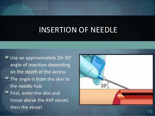 Vascular access for hemodialysis( AVF )