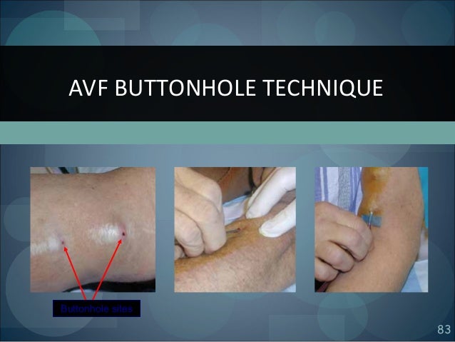 Vascular access for hemodialysis( AVF )