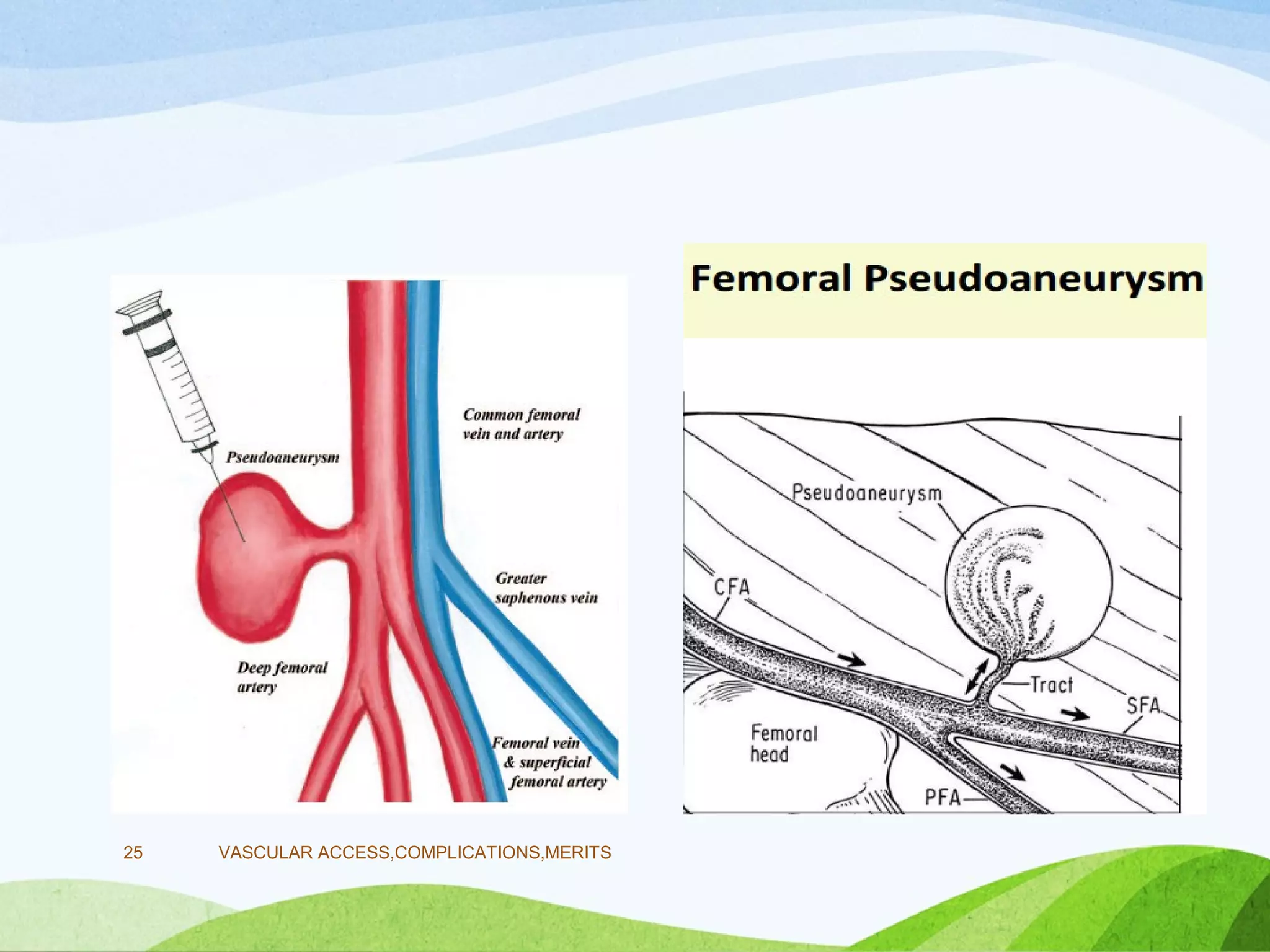 Vascular access in cardiac catheterization | PPT