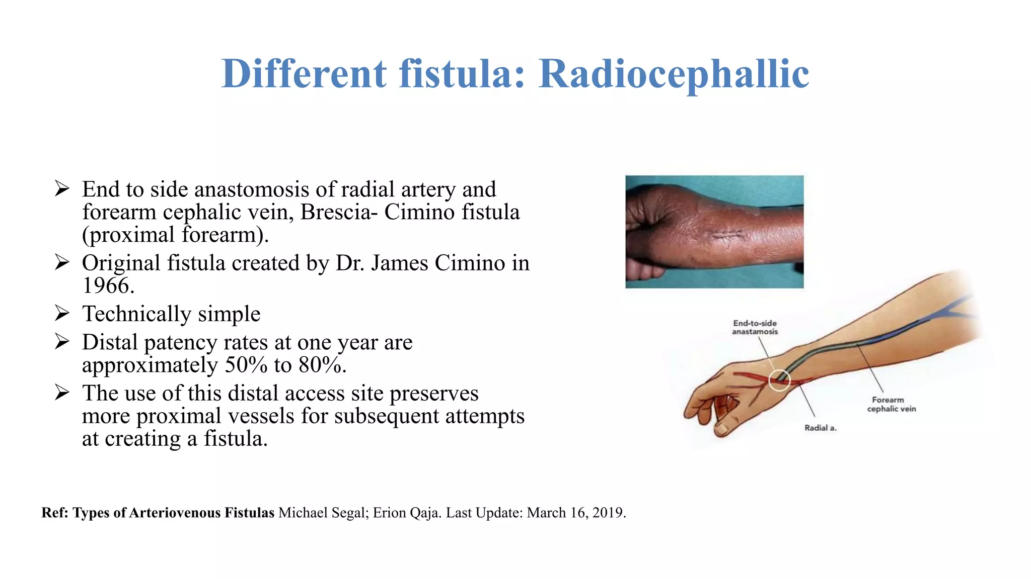 Vascular access in Haemodialysis (2).pptx