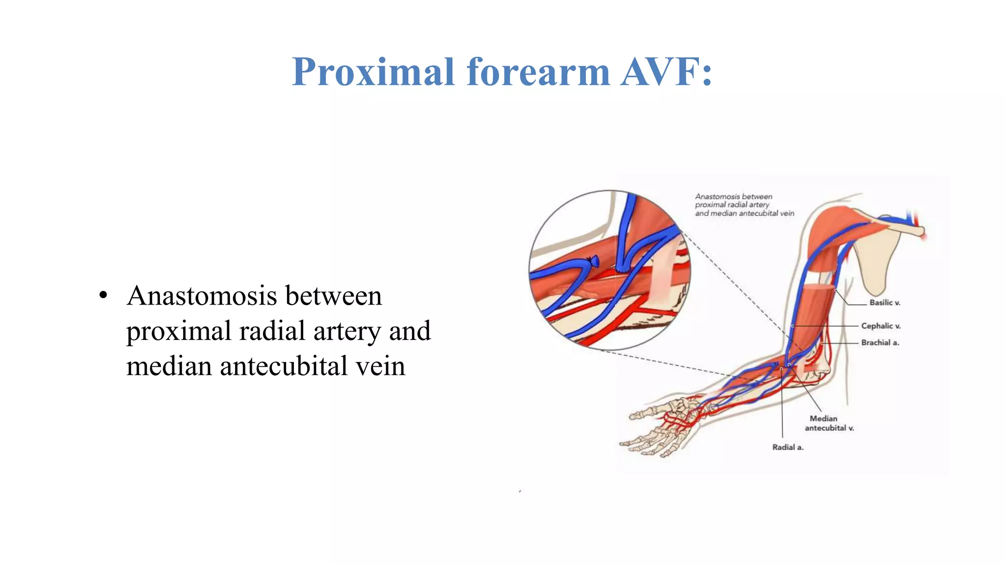 Vascular access in Haemodialysis (2).pptx
