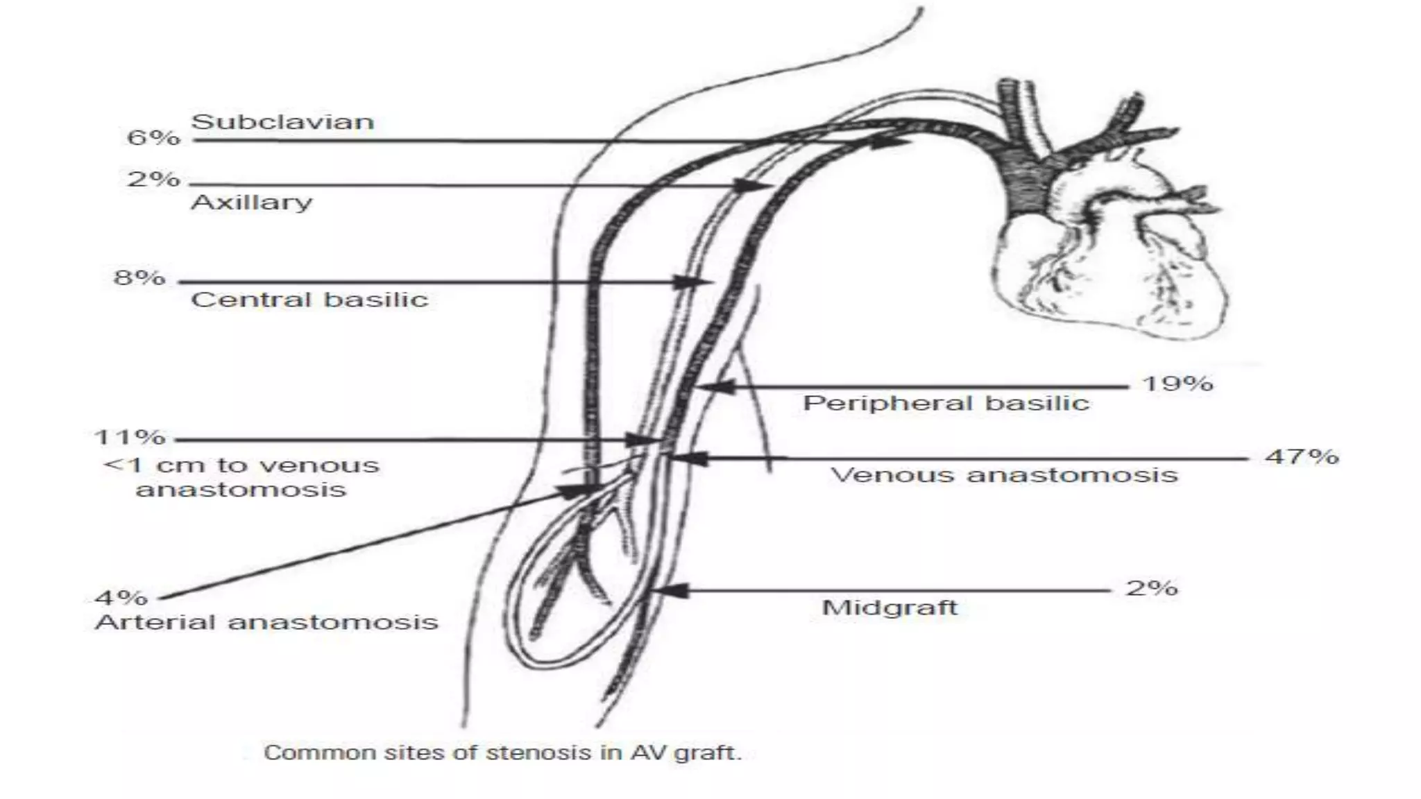 Vascular Access In Haemodialysis 2pptx