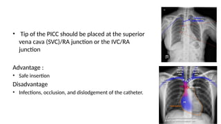 Vascular access in pediatric population. | PPTX