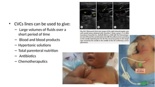 Vascular access in pediatric population. | PPTX