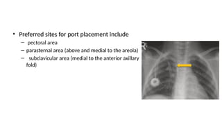 Vascular access in pediatric population. | PPTX