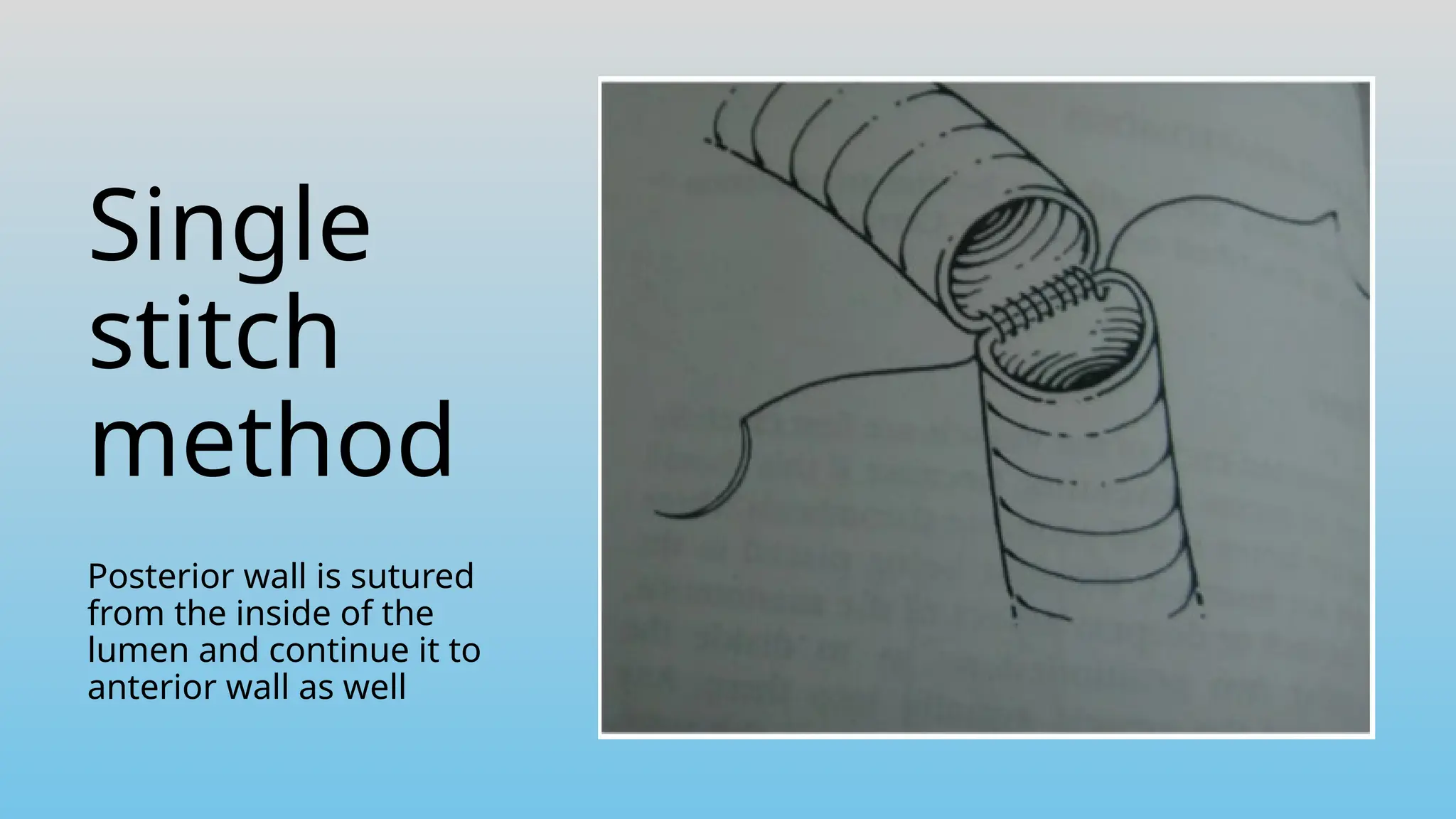 Principles of Vascular Anastomosis .pptx