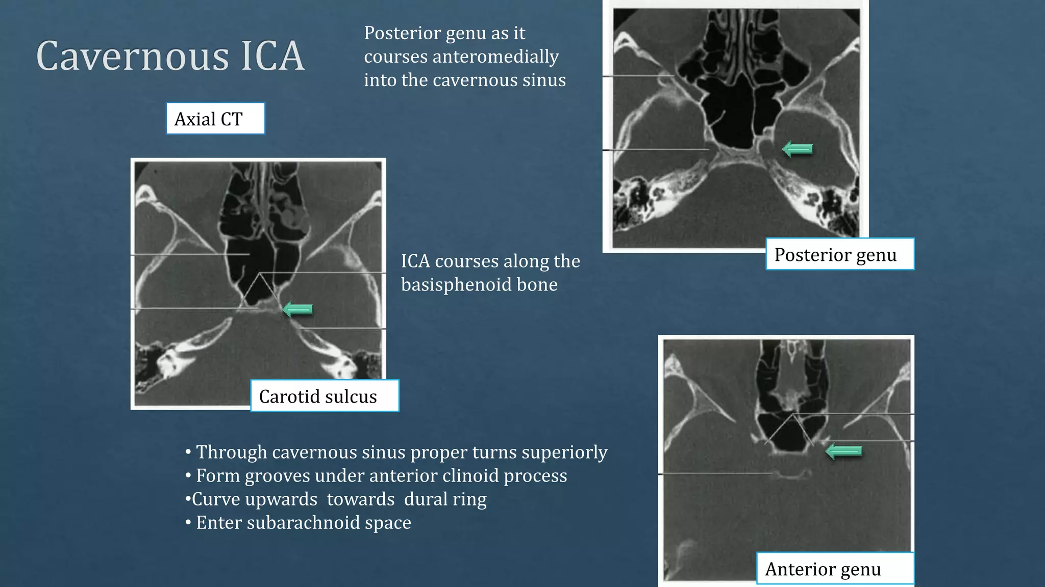 Radiological vascular anatomy of brain | PPTX