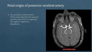 Posterior Cerebral Artery Mri