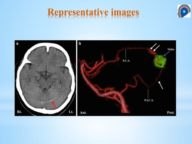 Vascular anatomy of posterior fossa | PPTX